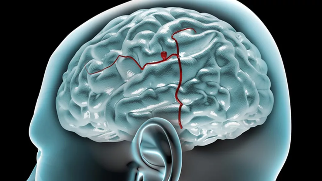 Se poate trăi cu anevrism? Iată ce spun medicii • Buna Ziua Iasi • BZI.ro