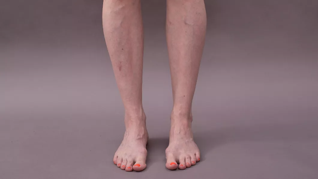 Vene vizibile pe picioare. Care este factorul provocator și semnele ...