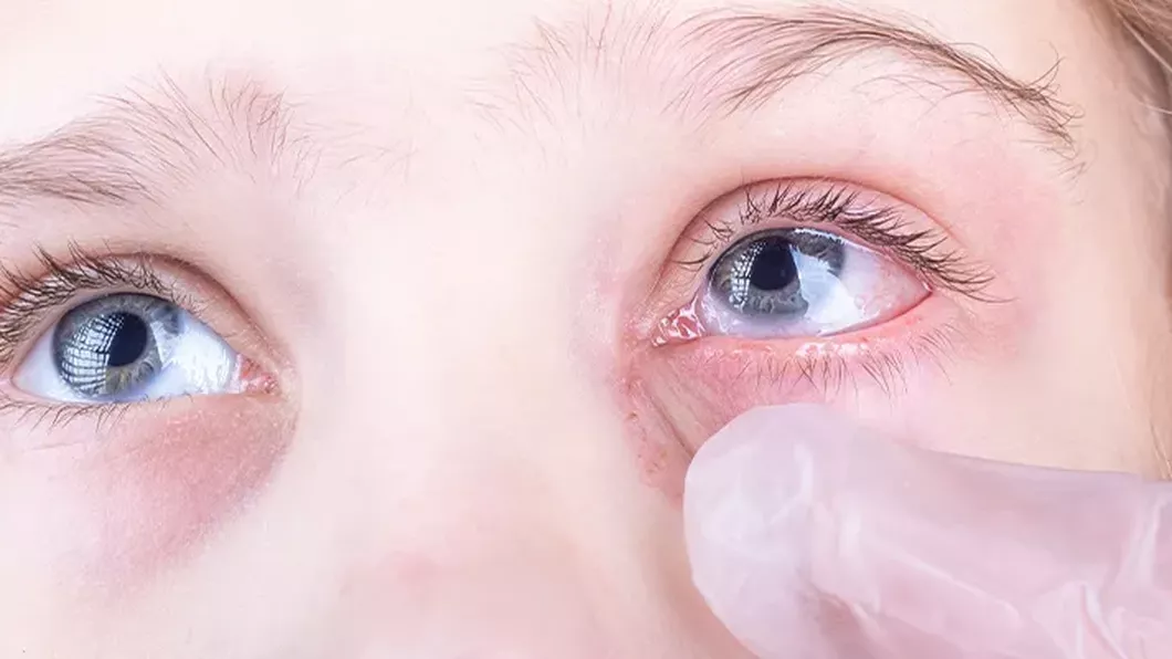 Secreție galbenă la ochi copii. Afecțiunile care provoacă manifestarea ...