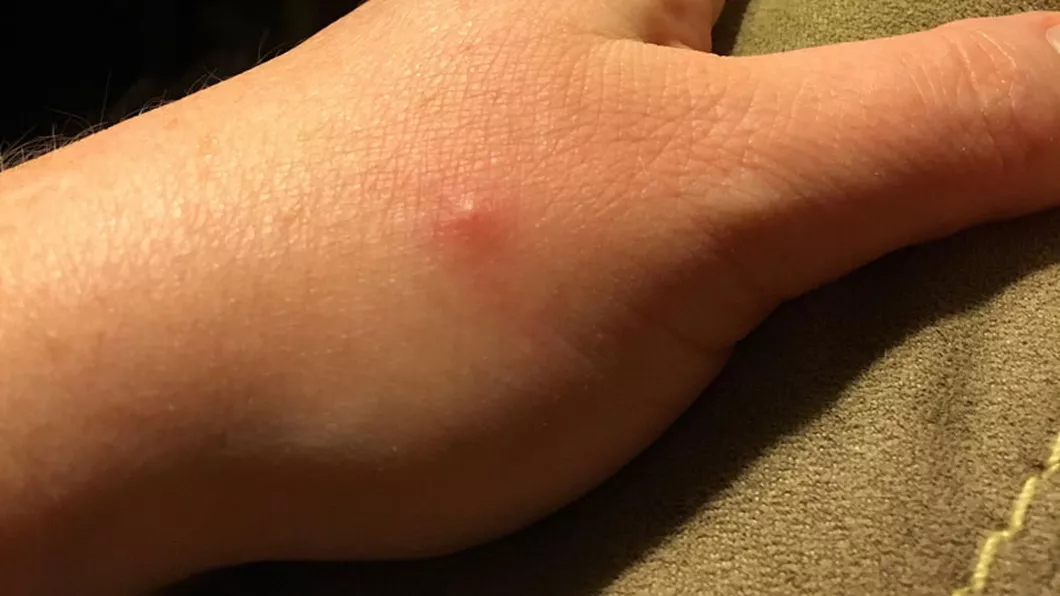 Bubițe pe mâini ca niște coșuri. Ce afecțiuni provoacă iritațiile și ...