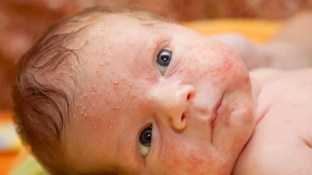 Poze cu bubițe la copii. Bolile contagioase care provoacă manifestarea ...