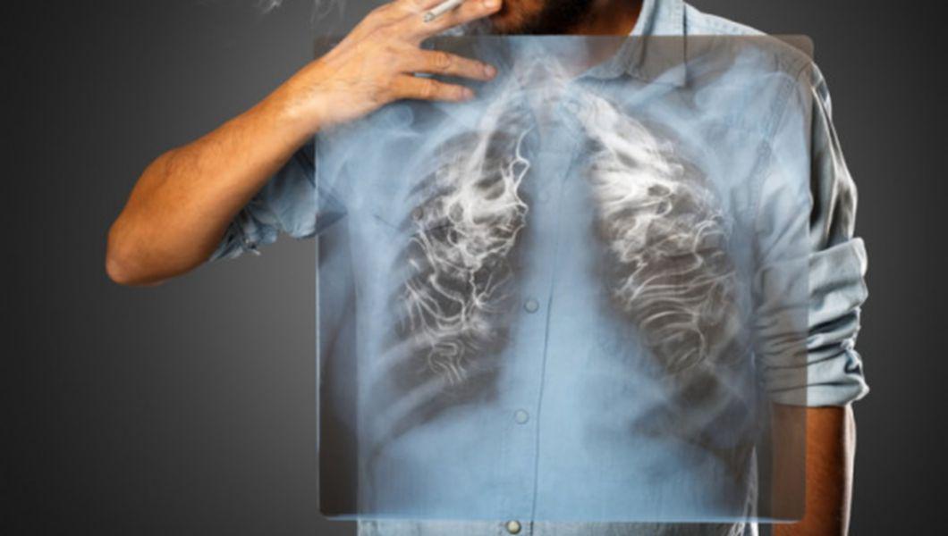 Cancer la plămâni: Cum îți dai seama că te-ai îmbolnăvi Cancer la ...