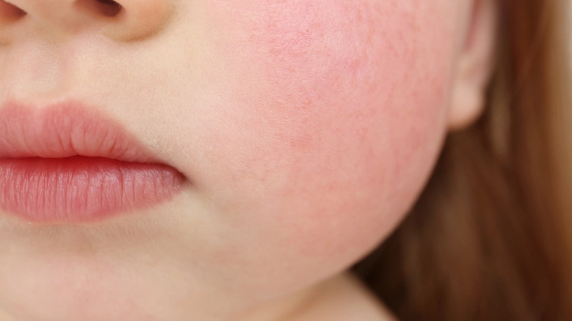 Petele roșii pe față la copii – De ce apar și ce opțiuni de tratament ...