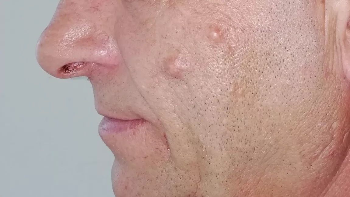 Chist sebaceu infectat. Cât de complicat este procesul de vindecare