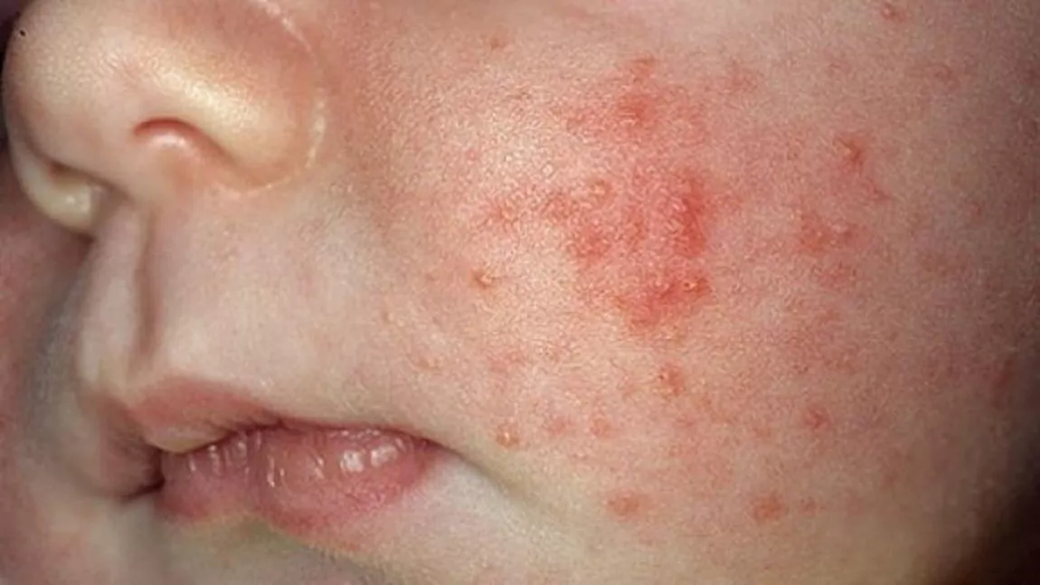 Boli de piele la copii. Afecțiuni frecvente, simptome și imagini • Buna ...