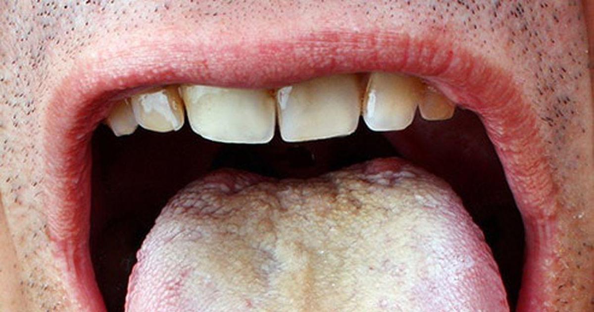 Candidoza bucală: Tratament cu bicarbonat