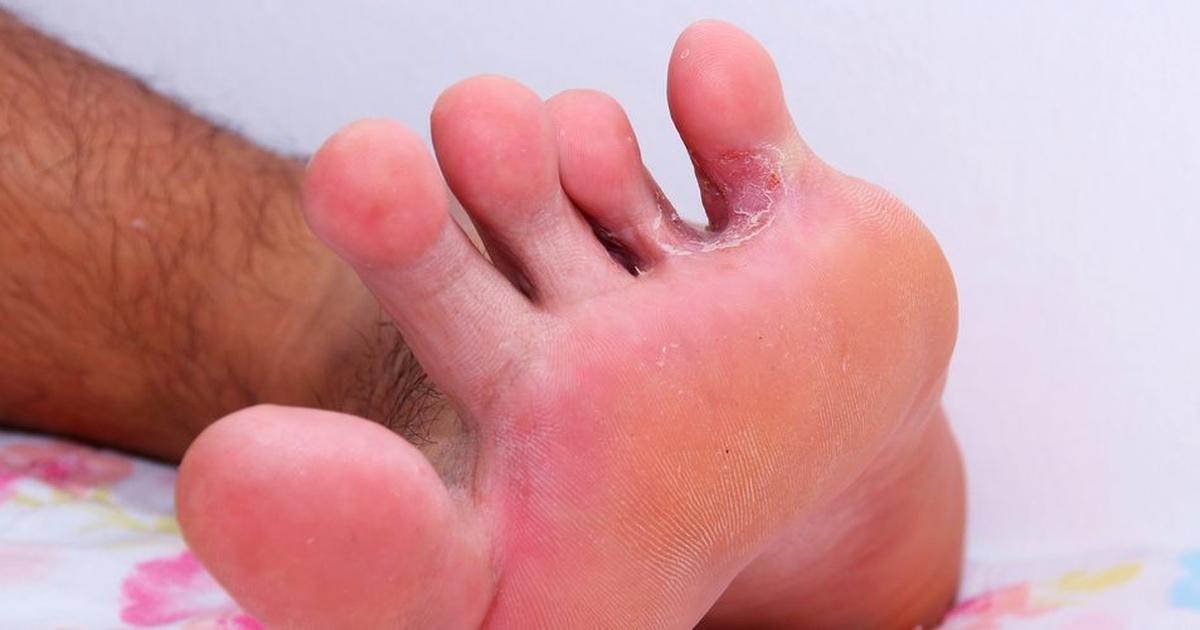 Tipuri de ciuperci de piele poze: Când trebuie să te adresezi la medic