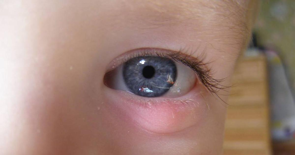 Umflătură sub ochi: Care sunt cauzele care duc la apariția acesteia și ...