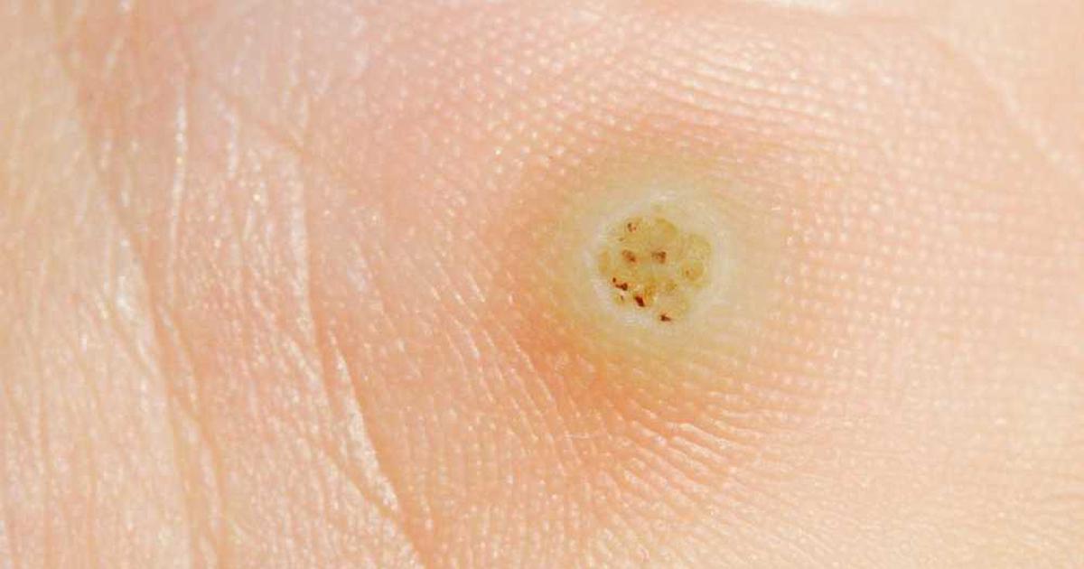 Totul despre veruci: Tipuri, cauze și tratament naturist • Buna Ziua ...