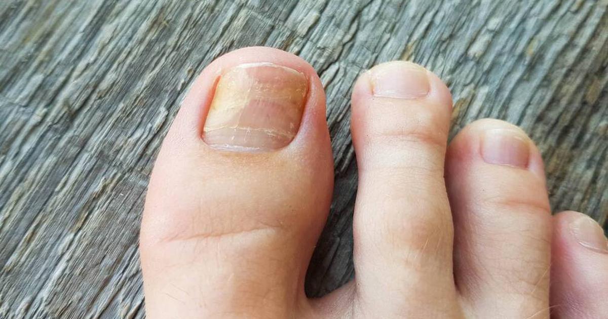 Sunt recomandate antibioticele pentru micoza unghiei? Află ce spun ...