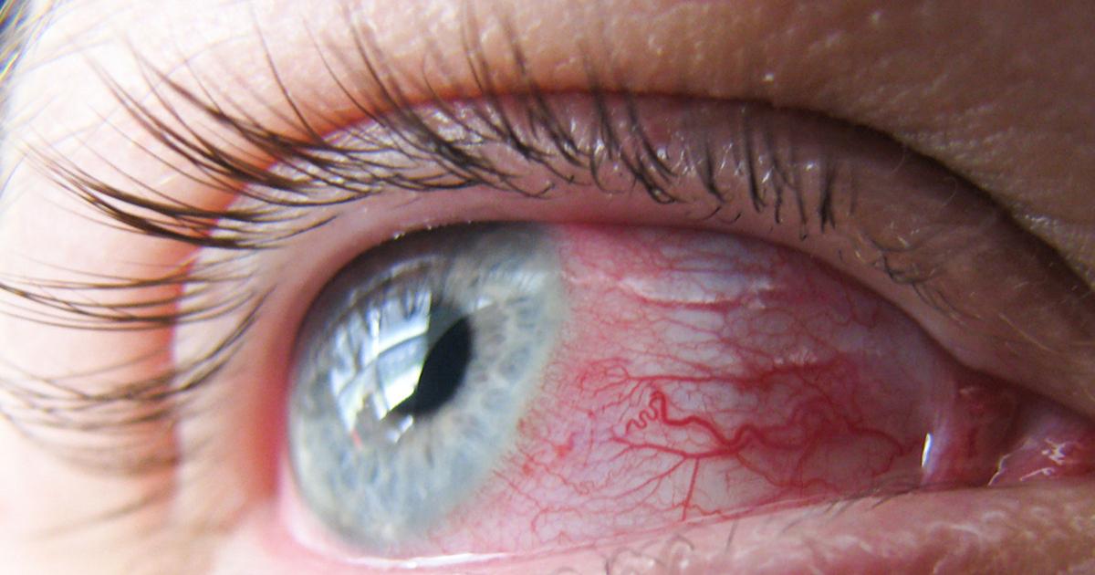 Ochiul roșu și umflat, o urgență oftalmologică! Cauze și tratament ...