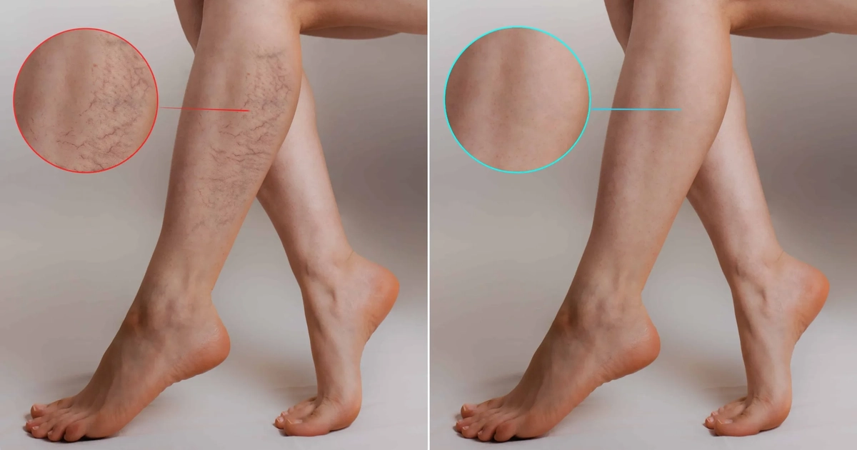 Ulcer varicos: poze, cum se manifestă și când este cazul să mergeți la ...