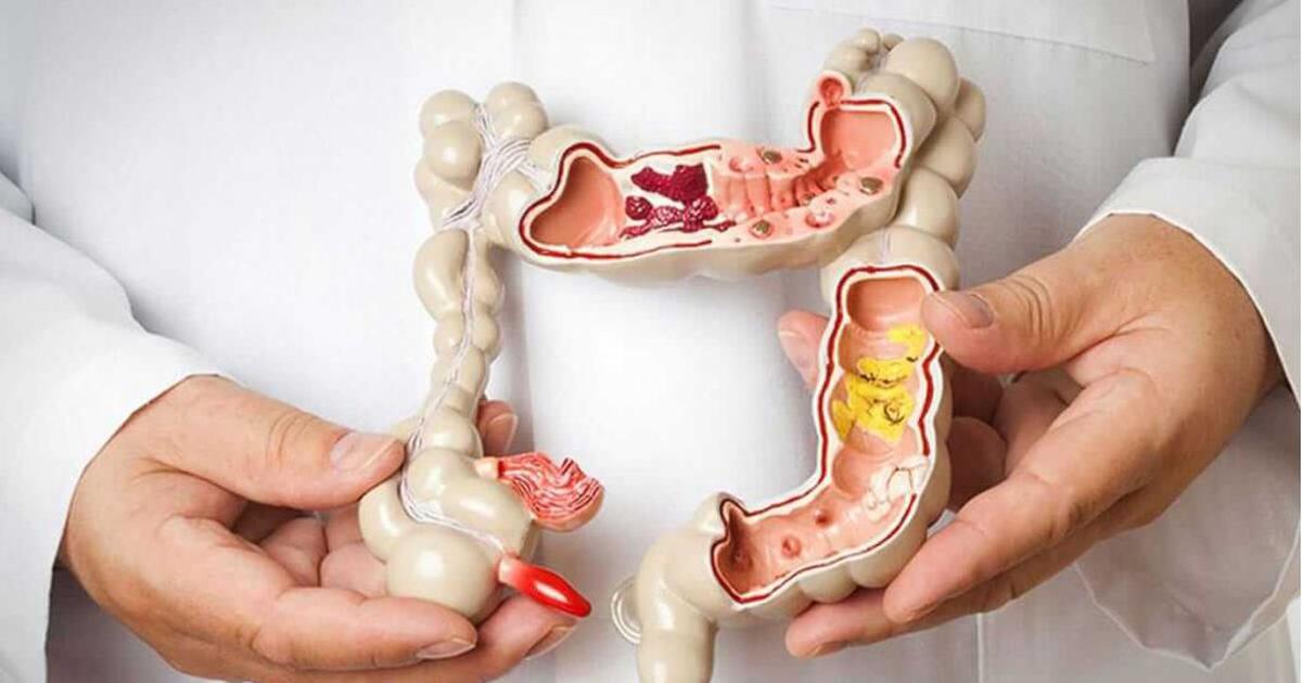 Cancer de colon – poze. Din ce cauze apare tumora?