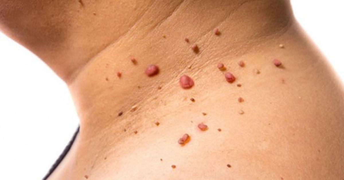 Soluție de îndepărtare pentru papiloame. Ce metodă să folosești pentru ...