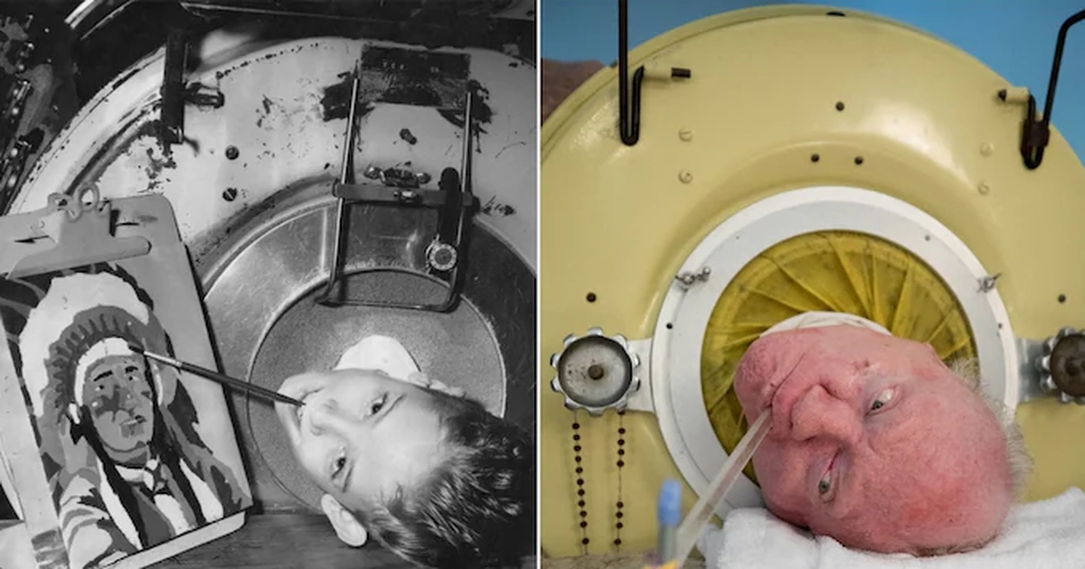 Paul Alexander, bărbatul care a trăit cu un plămân de fier, a murit la ...