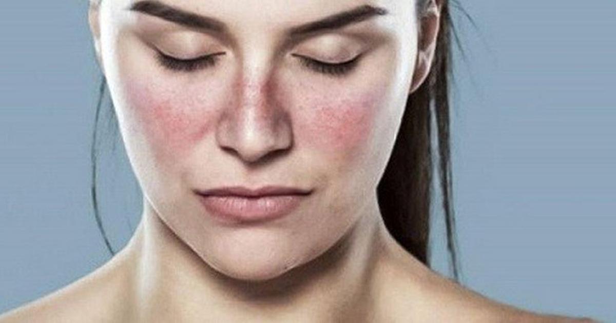 Ce este boala fluture, de fapt? Iată cum se manifestă celebra afecțiune ...