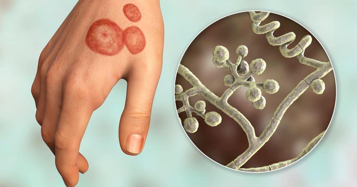 Ciuperca de piele, de la pete roșii la infecții grave. Semnele pe care ...