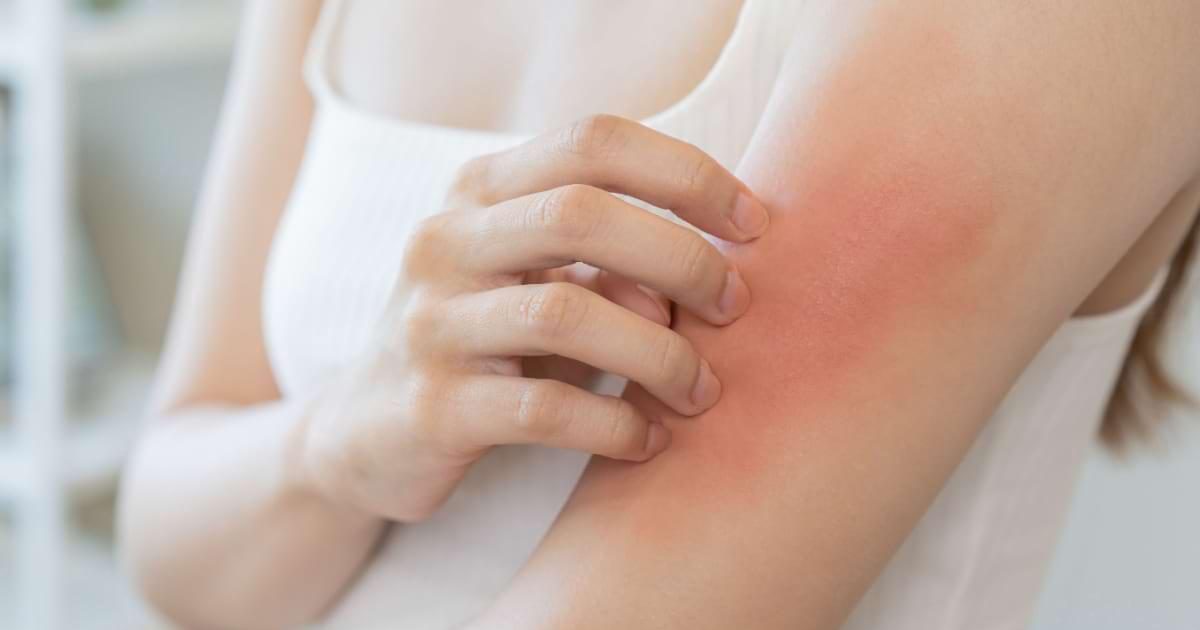 Alergie pe piele de la ficat, poze, simptome și cauze
