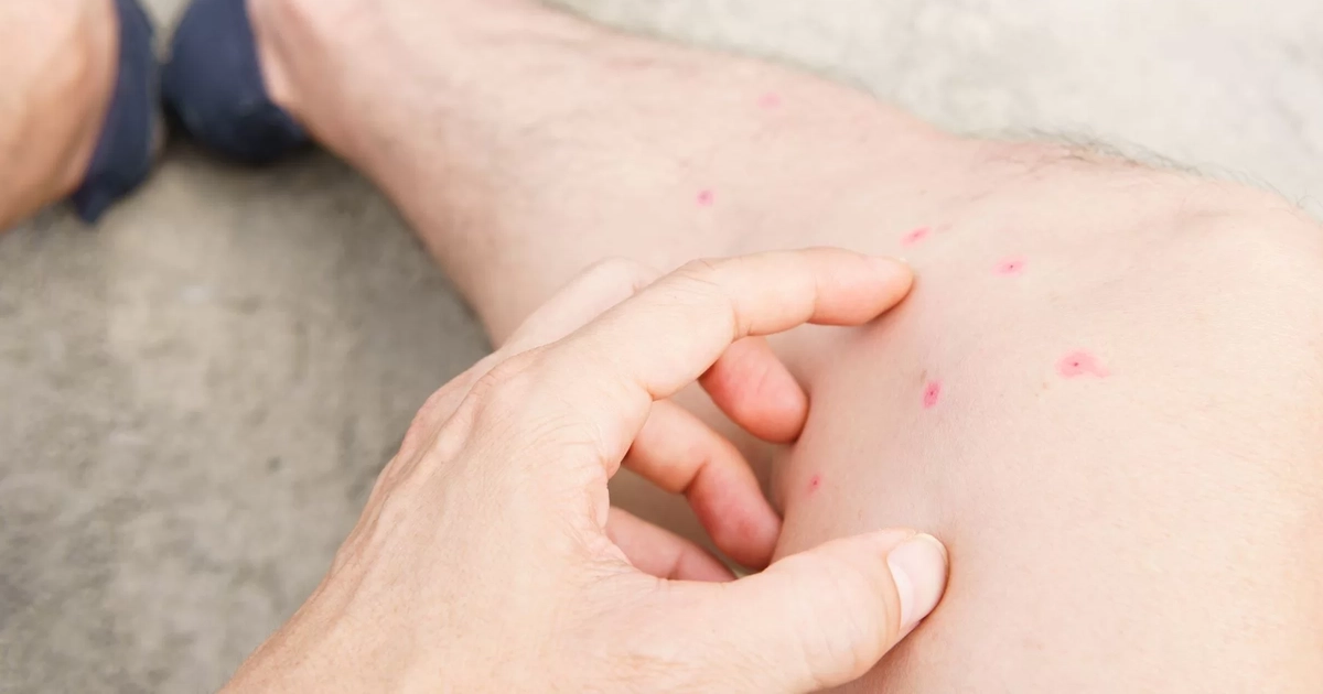 Ce semne apar dacă ai alergie la mușcătura de purice? Remedii pentru a ...