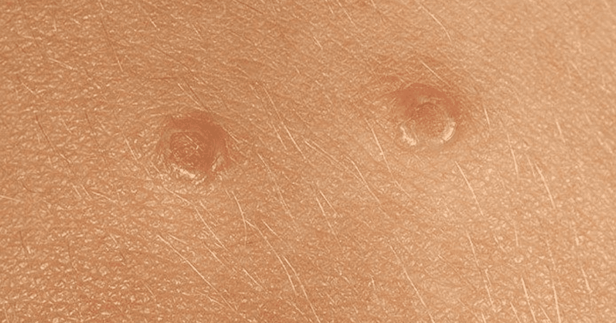 Bubițe în zona genitală la femei - poze. Cum să scapi de disconfort