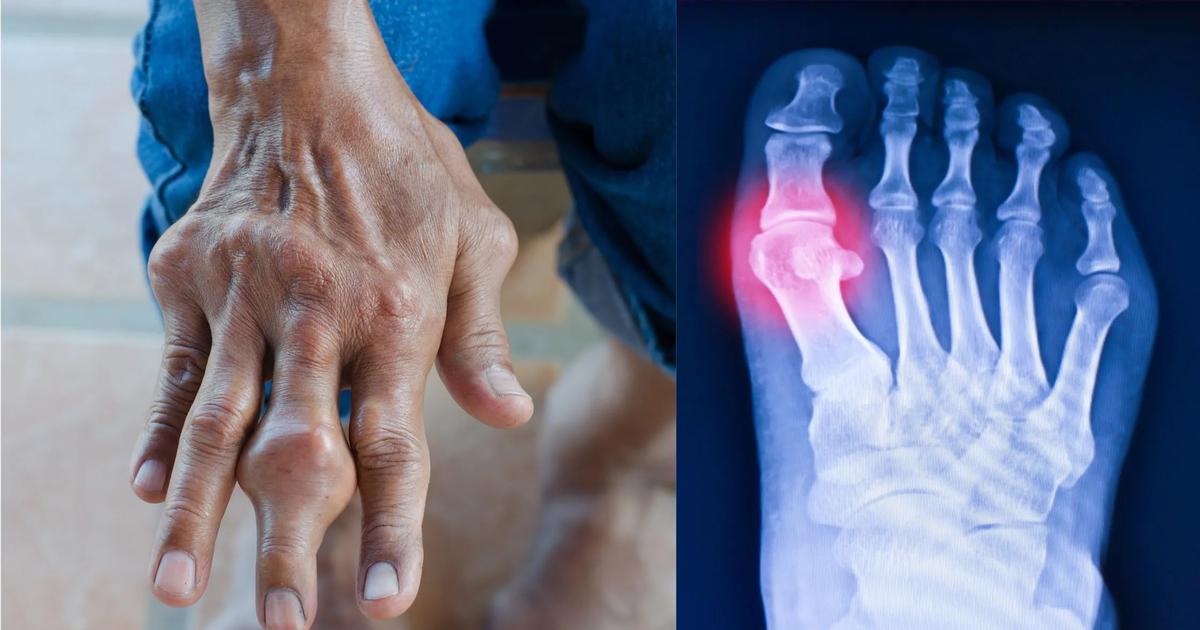 Ce e guta, boala cu episoade de durere intensă și umflături ale ...