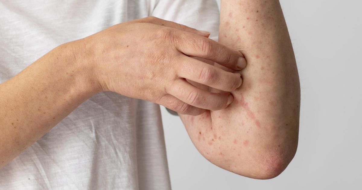 Rujeola la adulți. Cum se manifestă și se tratează pojarul