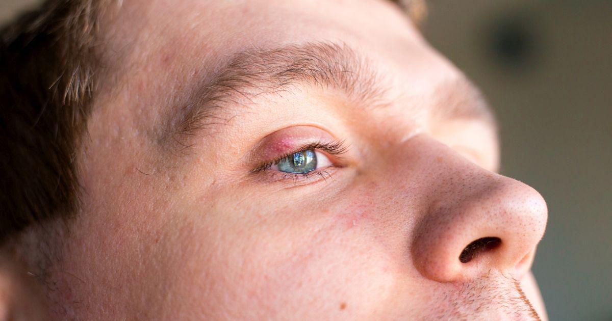 Scapă de ochii umflați de la curent! Remedii naturale