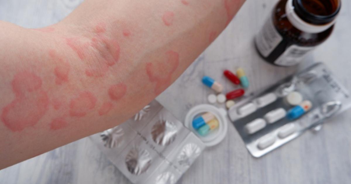 Cât durează alergia la medicamente? Iată cum se manifestă și care este ...