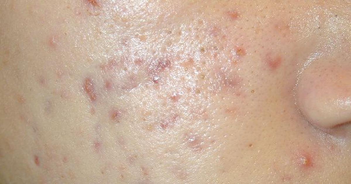 Ai ramas cu pete pe fata de la acnee? Iata cateva remedii naturale ...