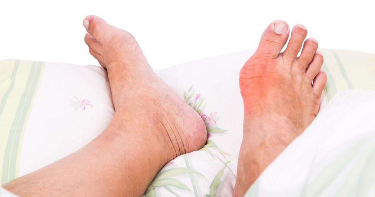 Guta la picior, afecțiunea care dă multora bătăi de cap. Care sunt ...