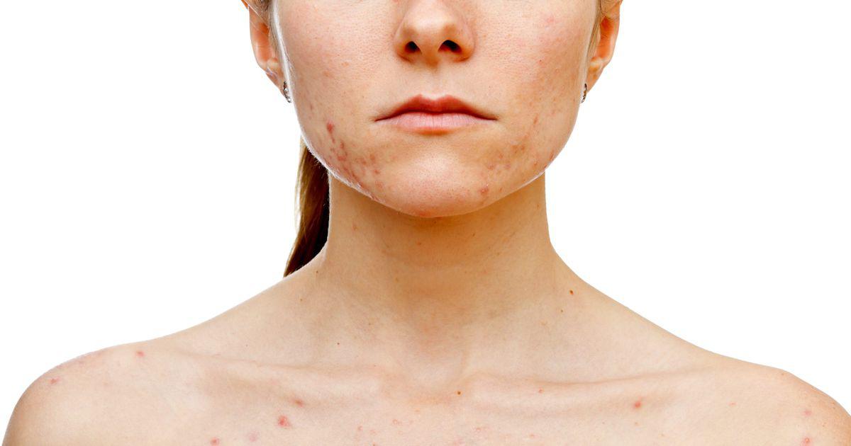 Pete roșii pe corp poze: Principalele afecțiuni semnalate de acest simptom