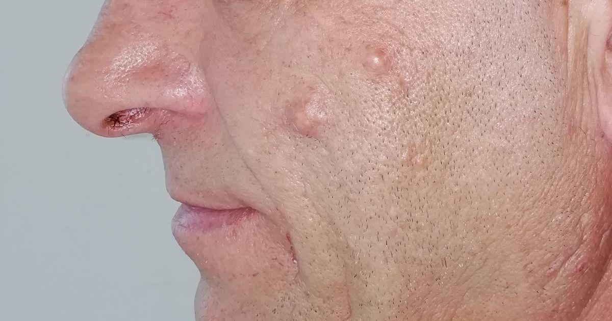 Chist sebaceu infectat. Cât de complicat este procesul de vindecare