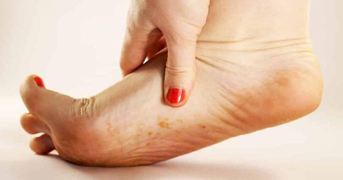 Ciupercă la picior. Remedii naturiste, ușor de pus în practică • Buna ...