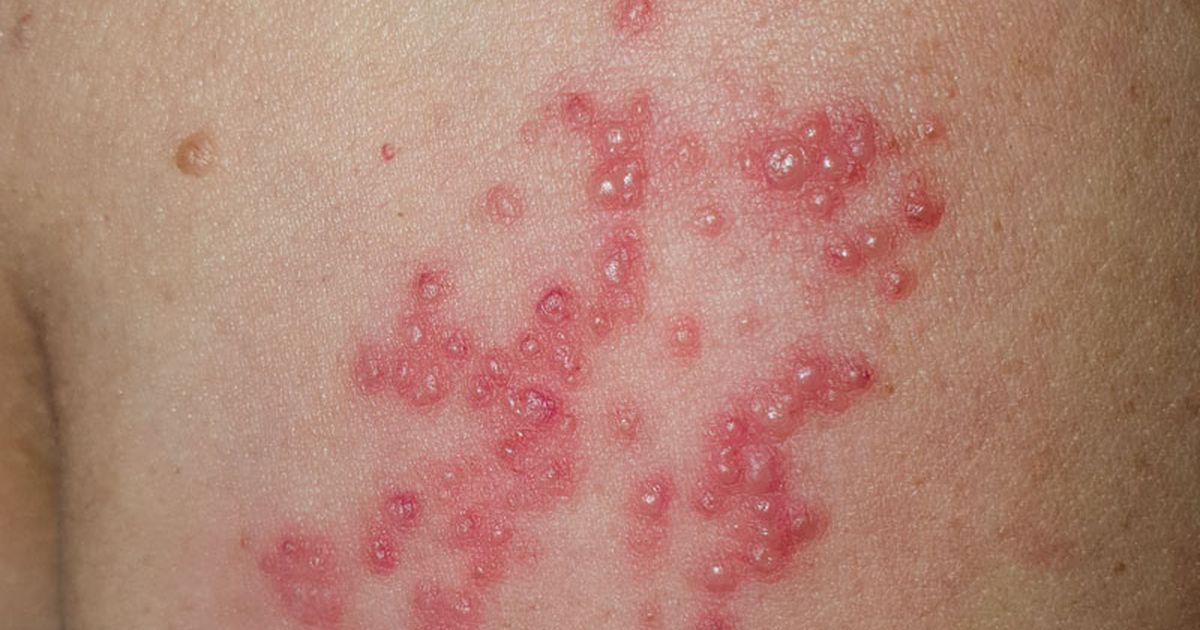 Unde apare zona zoster? Cauze, simptome și tratament • Buna Ziua Iasi ...