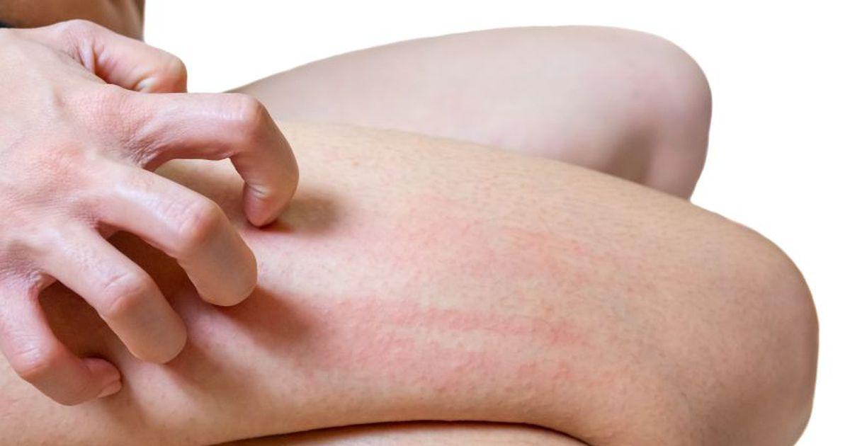 Mâncărimi de piele pe picioare. Situații care pot provoca manifestarea ...