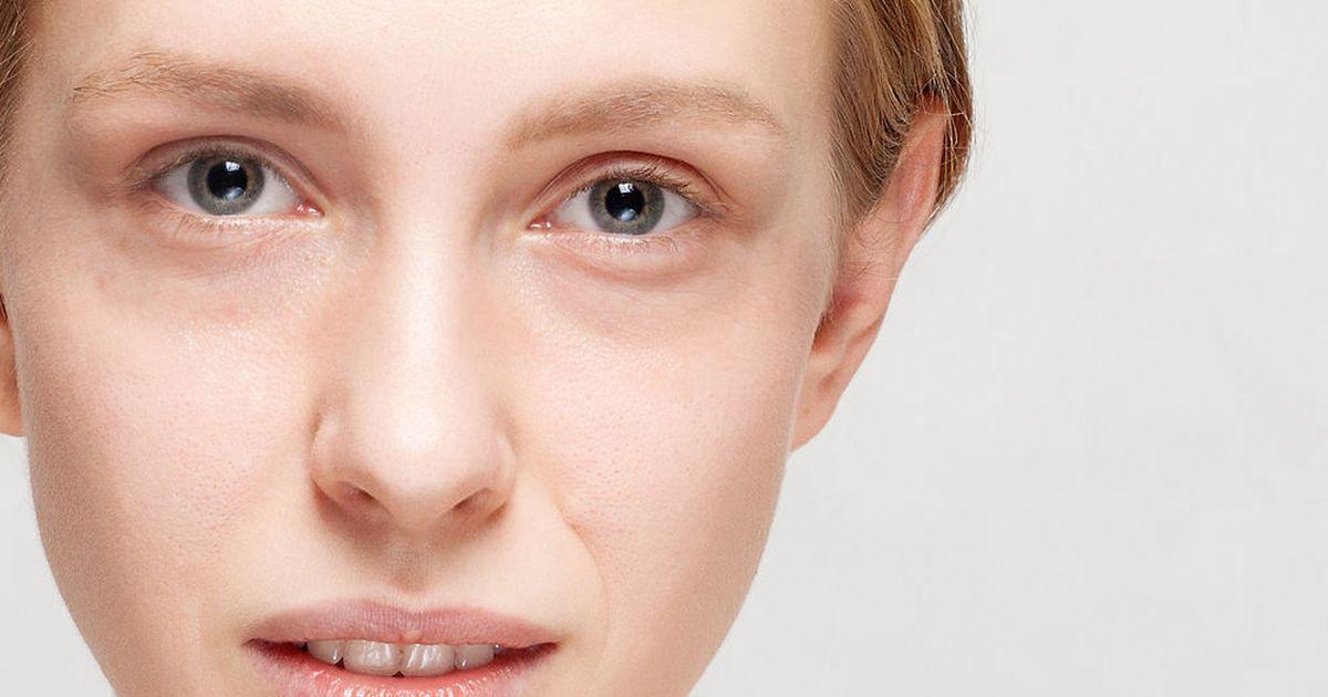 Ochi umflați dimineața. Cum să scapi definitiv de această problemă ...