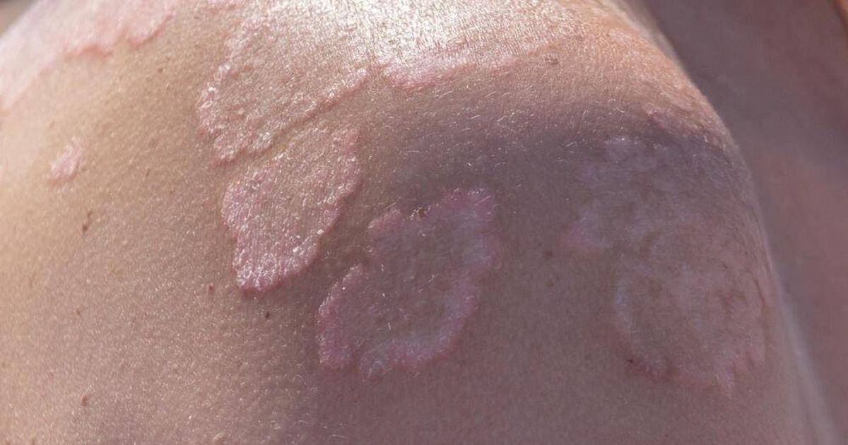 Pitiriazis versicolor. Ce tratament să administrezi pentru calmarea ...