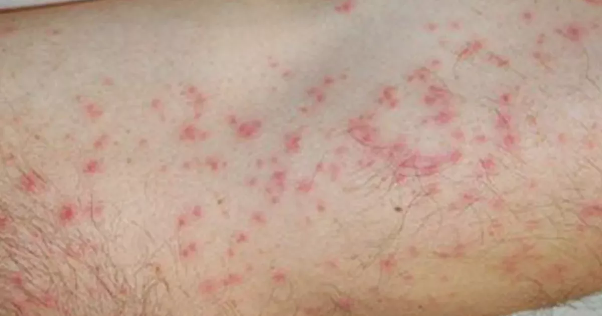 Bubițe roșii pe corp. Ce factori cauzatori sunt de vină