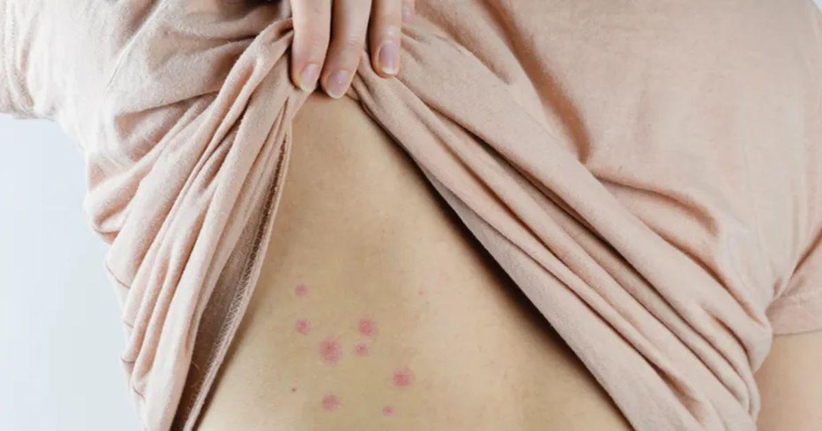 Mușcătura de purice, inofensivă sau un pericol pentru sănătate? Iată ...