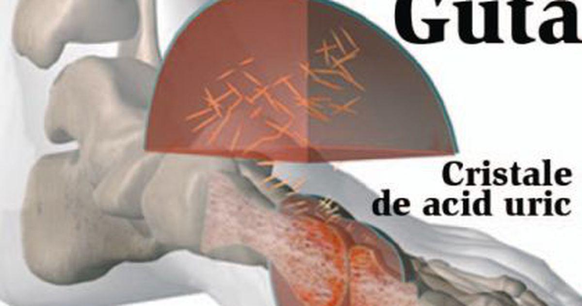 Tratament foarte bun pentru guta si articulatii bolnave • Buna Ziua ...