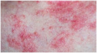 Pete roșii pe corp cu mâncărimi și umflături: Ce afecțiuni grave pot ...