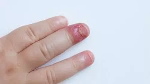 Puroi la deget: Cauze, simptome și tratament ale panarițiului