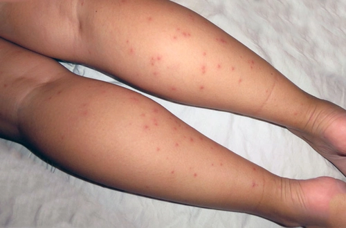 Ciupitura de purice: Cum să identifici rapid mușcătura insectei