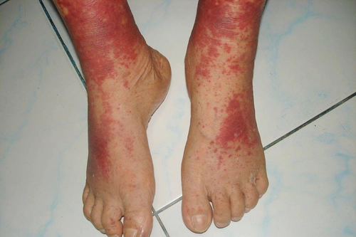 Arterita la picioare. Cauze, simptome, tratament și poze • Buna Ziua ...
