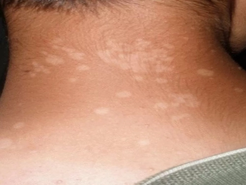 Pete pe piele de la ficat: Poze care te vor determina să apelezi la un ...