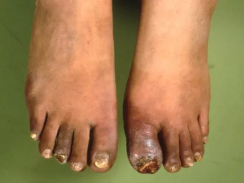 Arterita la picioare. Cauze, simptome, tratament și poze • Buna Ziua ...