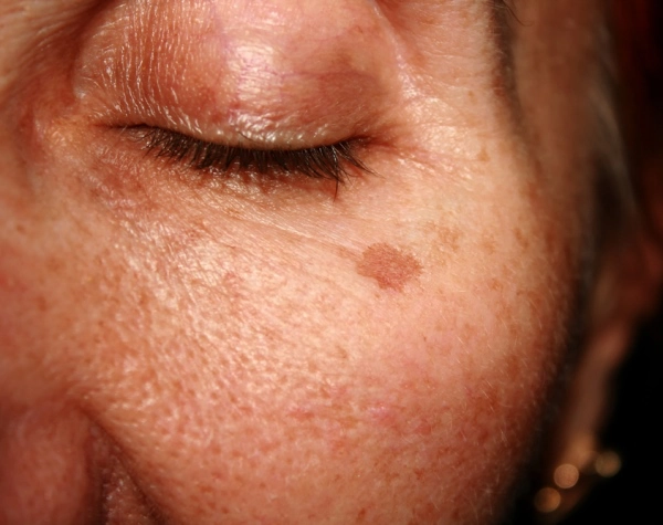 Pete maronii pe piele. Cauze, remedii naturiste și poze • Buna Ziua ...