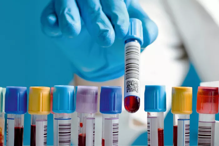 RDW crescut. Interpretarea indicatorilor de analiză hematologică