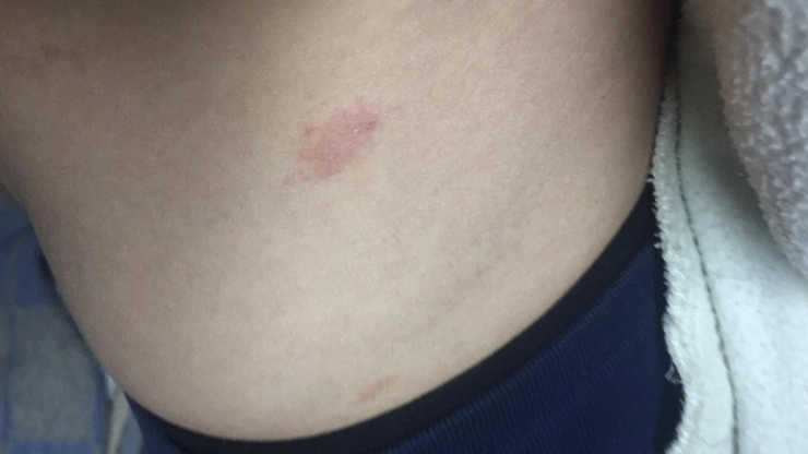 Pete roșii pe piele fără mâncărimi poze: Din ce cauză acestea apar și ...