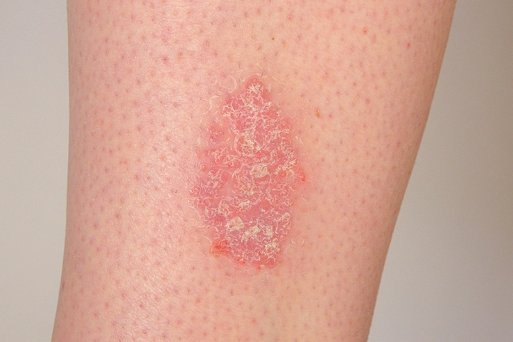 Tipuri de ciuperci de piele poze: Când trebuie să te adresezi la medic